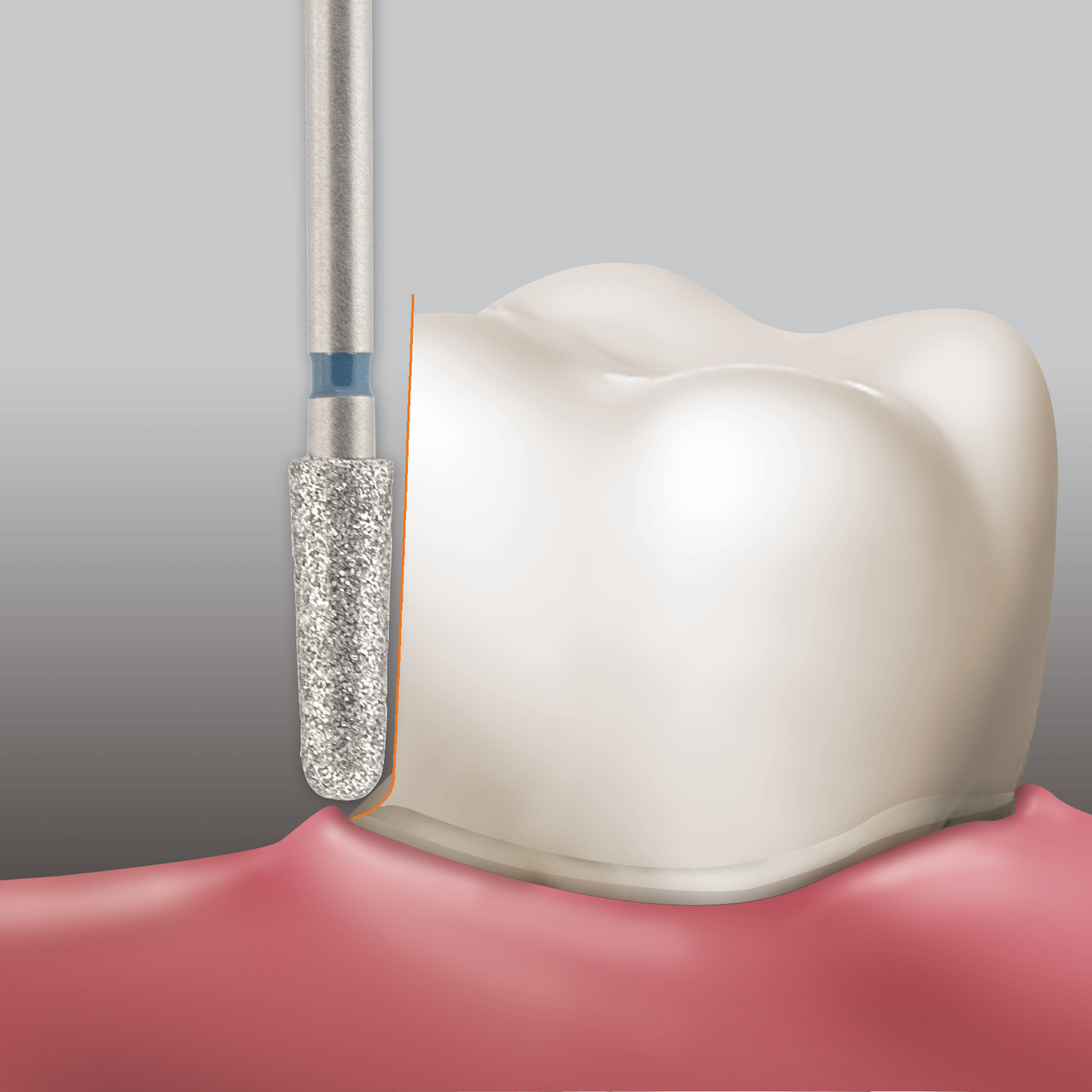 850C Diamond Bur Tapered round end (FG)