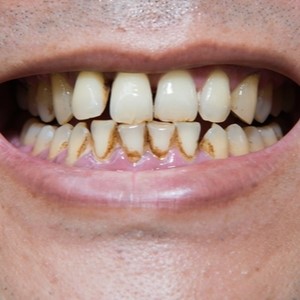 Is Vaping Bad For Your Teeth? - V2 Vaping UK