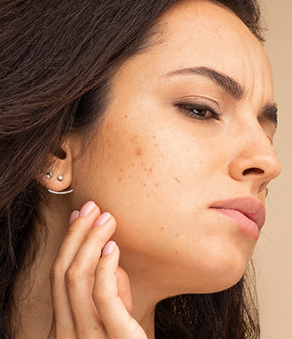 Buy Ayurvedic Products for Acne