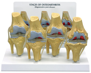 4 Stage Osteoarthritis Knee Degeneration Model
