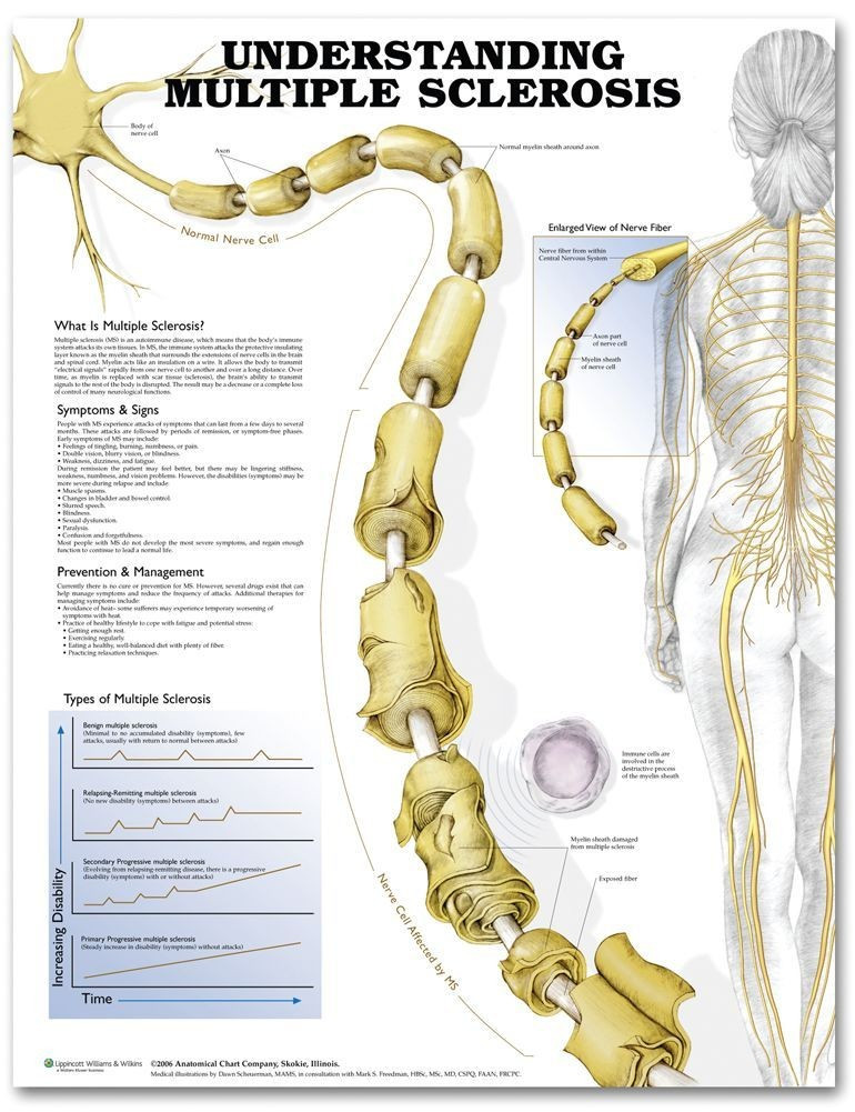 Understanding Multiple Sclerosis Anatomical Chart