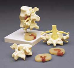 Lumbar Set with Herniated Disc Model