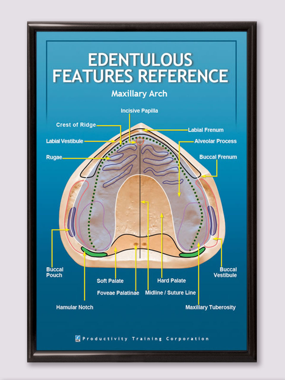 Maxillary Edentulous Features Poster - Blue Dolphin Products