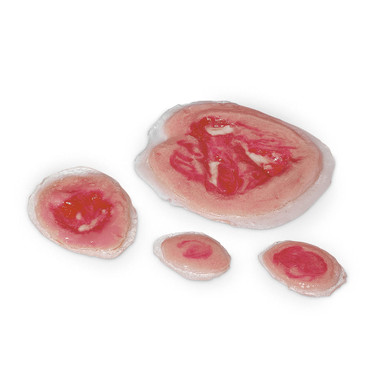 Nasco Pressure Ulcer Stage 4 Replacement