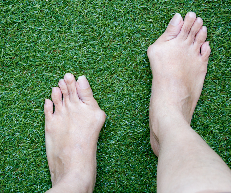 Understanding and Managing Hallux Valgus: Causes, Solutions, and Top ...