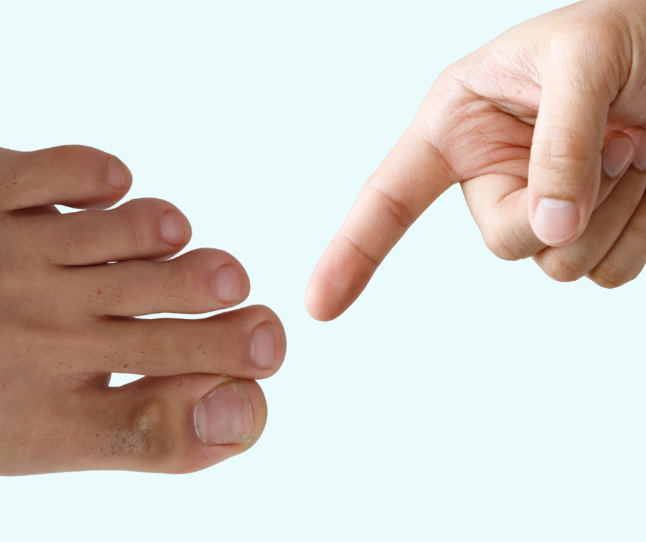 Discovering Comfort: Embracing Morton's Toe - Foot Solutions Vancouver