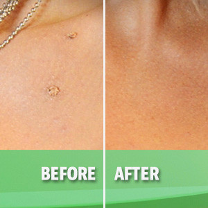 Natural SkinTag Remover