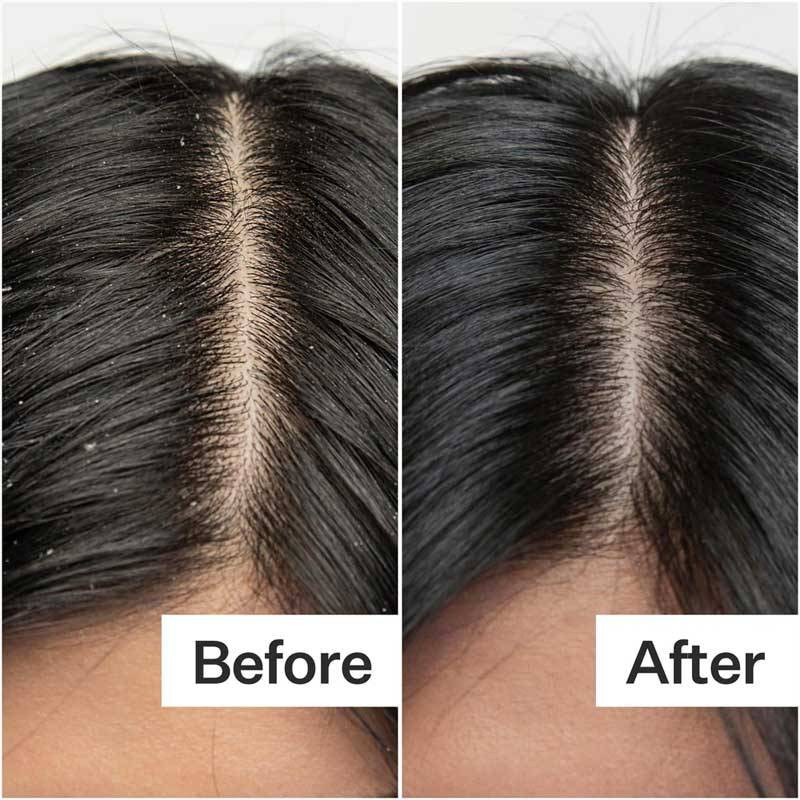 Dry Itchy Scalp 7 Hard Water Hair And Scalp Problems And Your Best