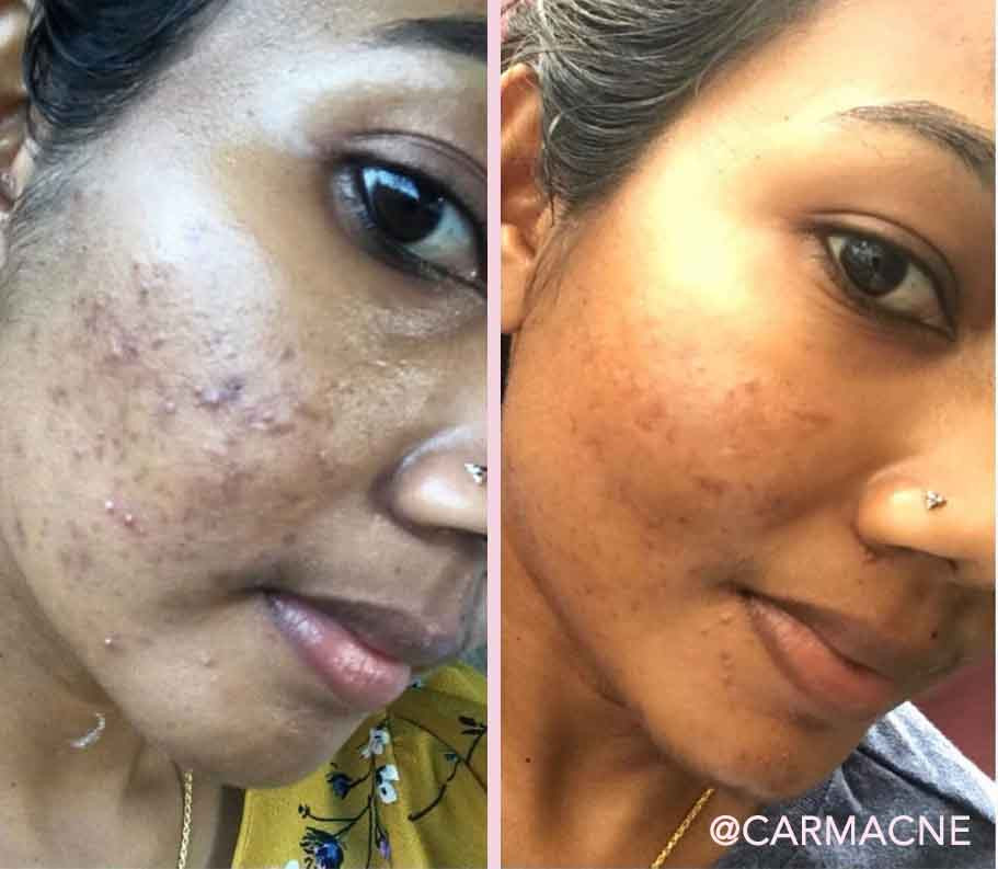 Cystic Acne KIT - Carm Acne Skincare