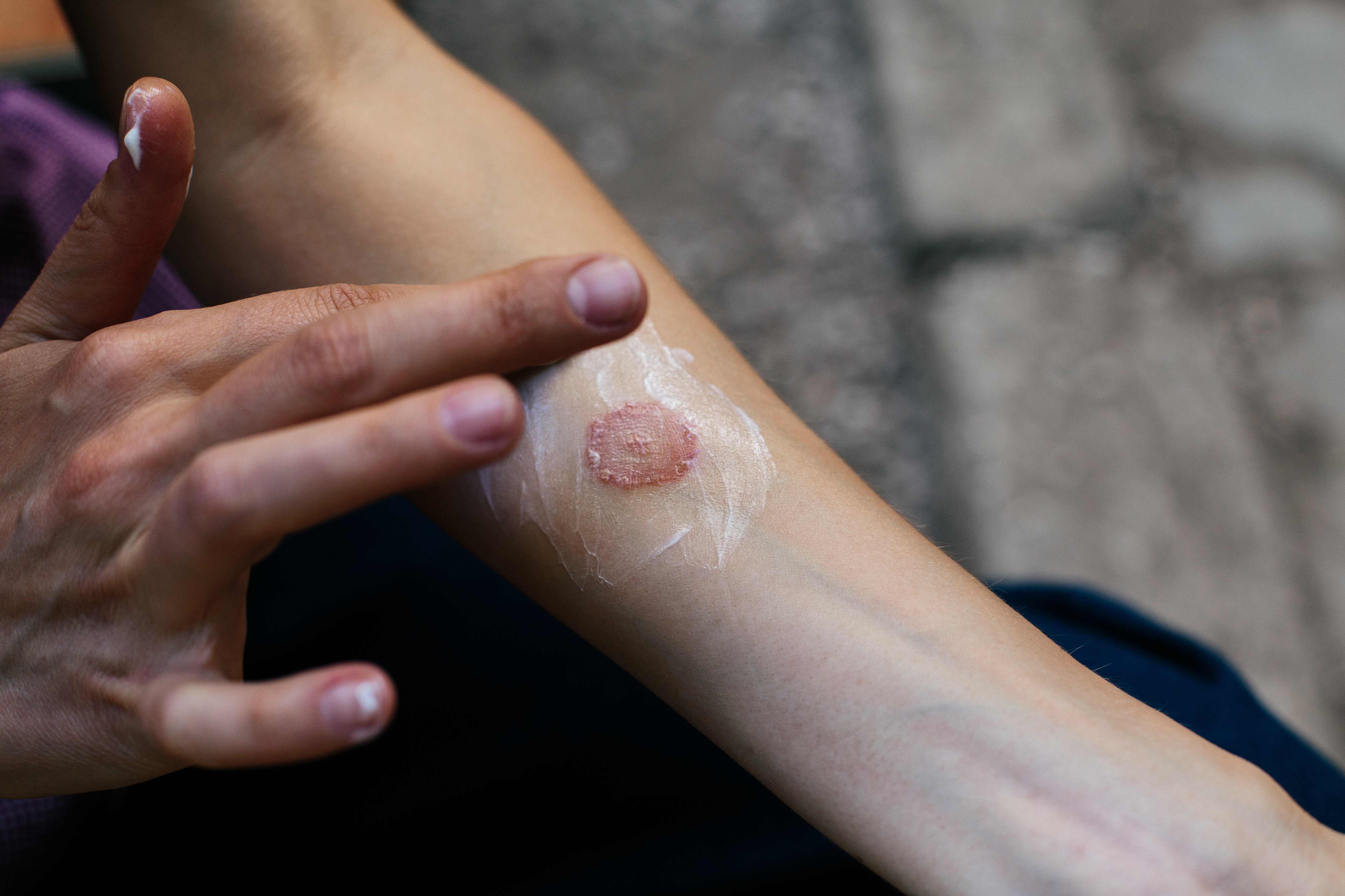 Put the Collar on Ringworm with These Natural Remedies - Wonder ...