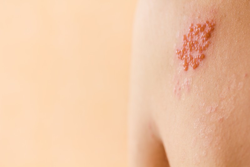 Six Natural Solutions for Shingles - Wonder Laboratories