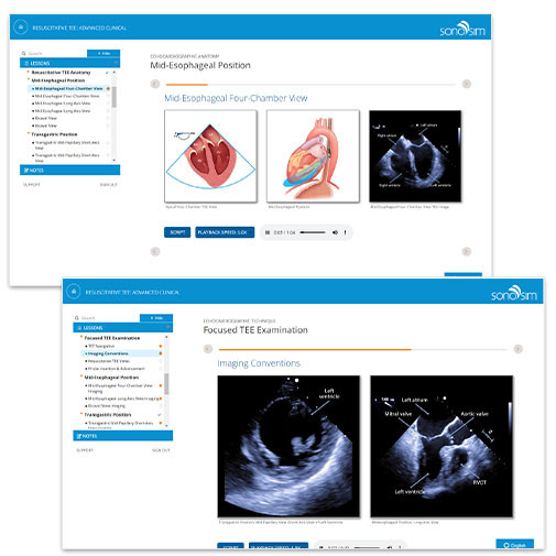 Transesophageal Echocardiogram TEE - Resuscitative TEE Ultrasound Training
