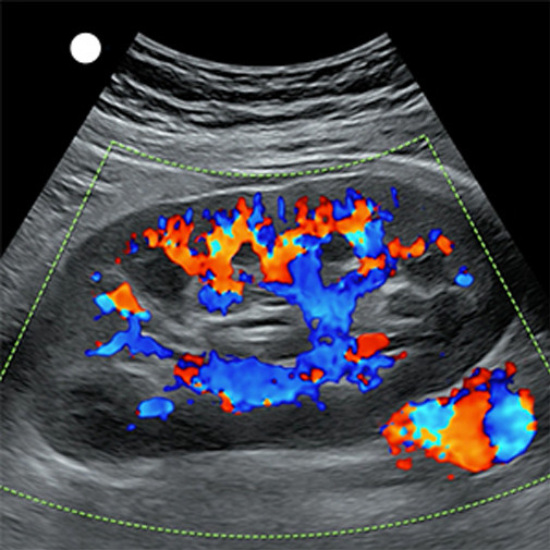 Renal Transplant Ultrasound Training