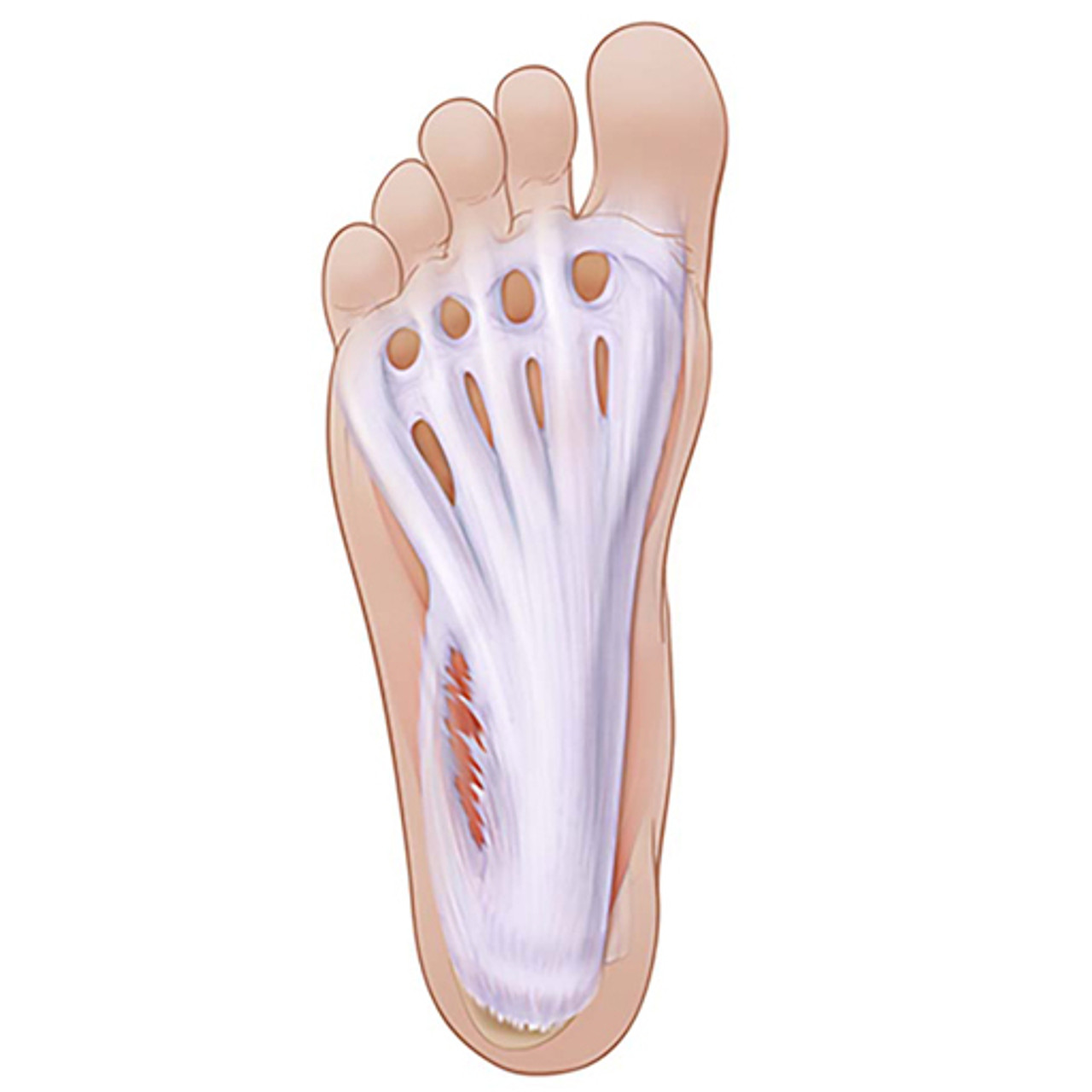 Plantar Fascia Ultrasound Guided Injections Procedure Module
