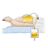 Paracentesis Procedure Training - Ultrasound-Guided Technique