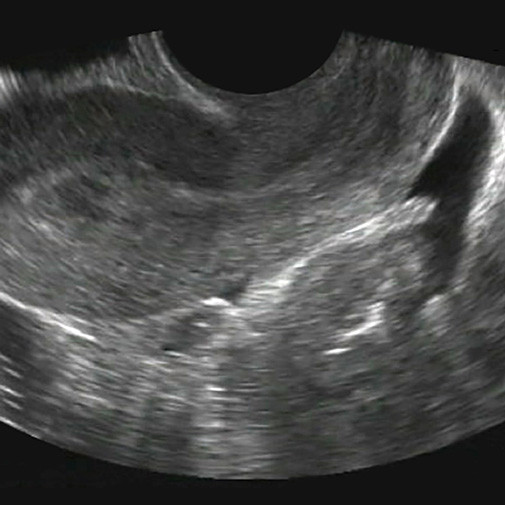 Basic Obstetric Ultrasound Course - POCUS OB 6 Step