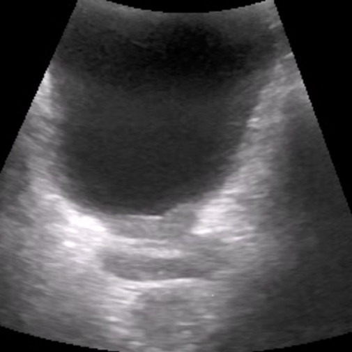 Prostate Ultrasound Training - Prostate Anatomy Ultrasound