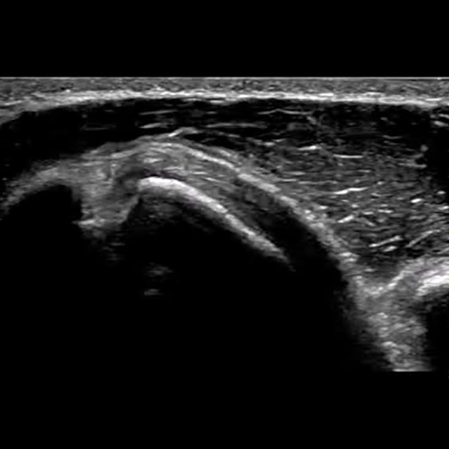 Glenohumeral Joint Injection Ultrasound - Procedure Training
