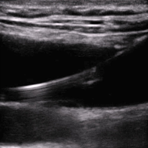 Femoral Central Line - Femoral Line Placement