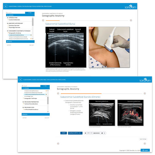 Subacromial Injection - Subacromial Shoulder Injection Ultrasound