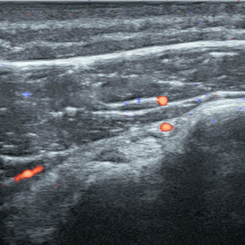 Glenohumeral Joint Injection Ultrasound - Procedure Training