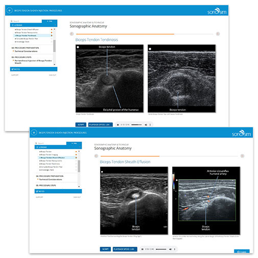 Ultrasound Training - Biceps Tendon Sheath Injection Procedure