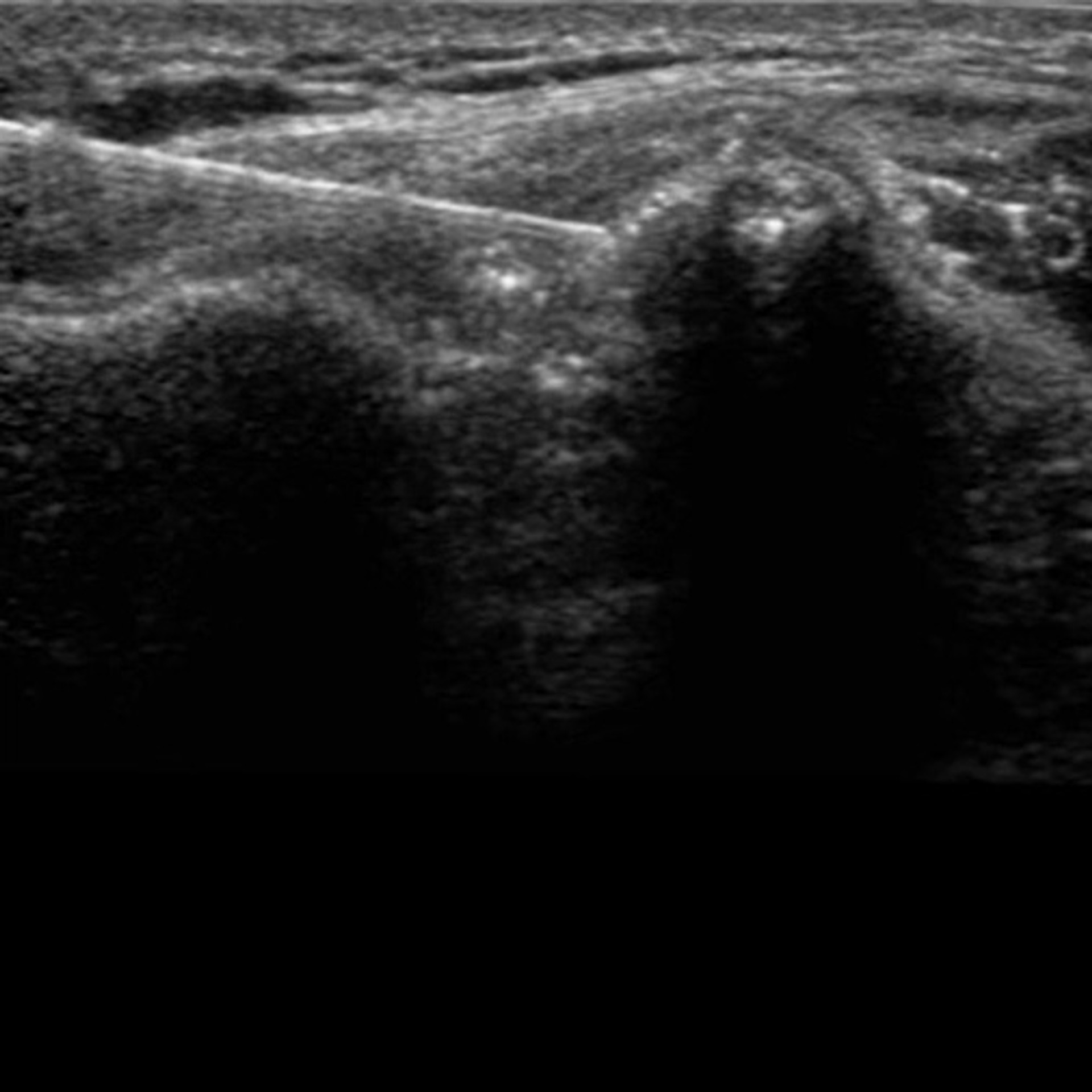 Glenohumeral Joint Injection Ultrasound Procedure Training