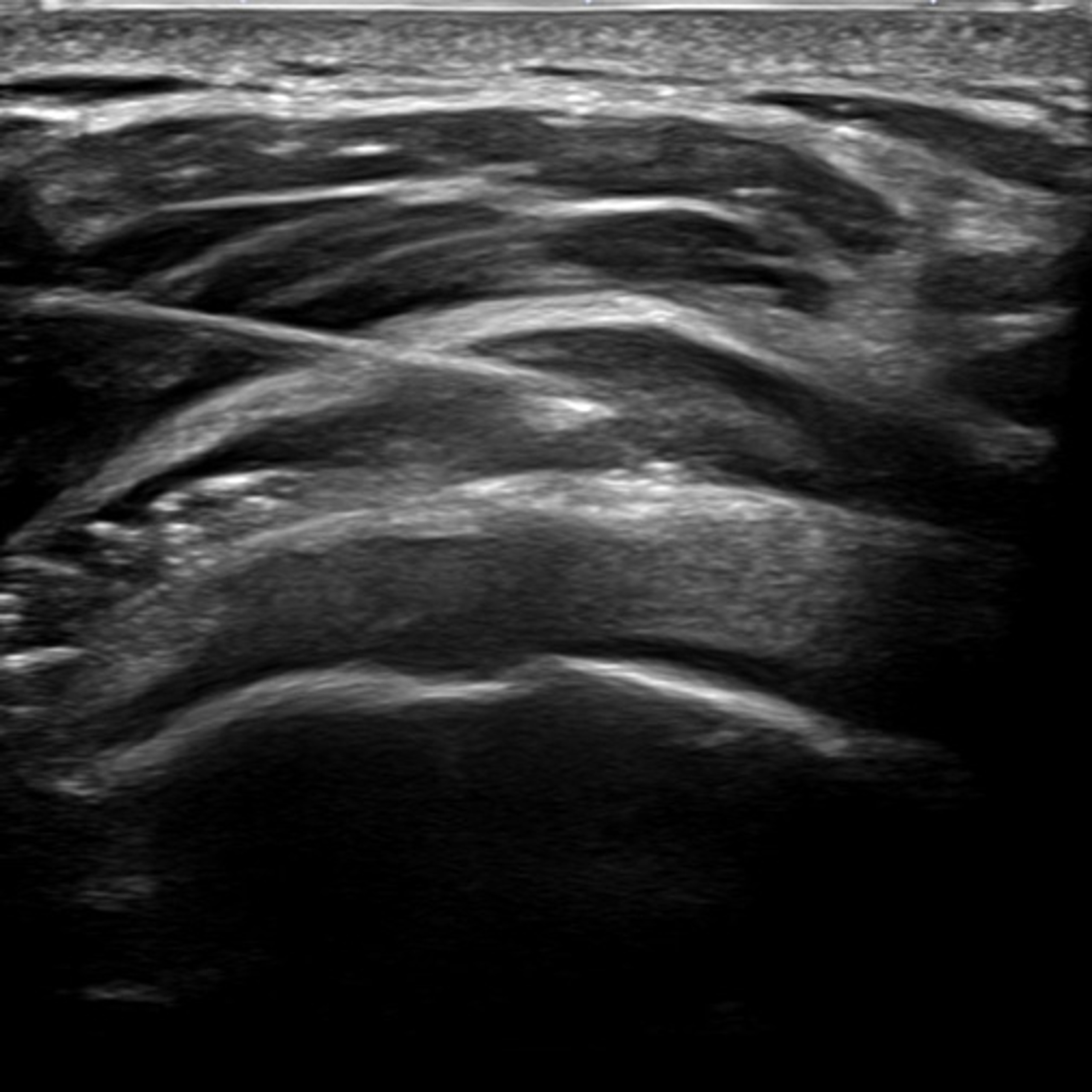 Glenohumeral Joint Injection Ultrasound Procedure Training