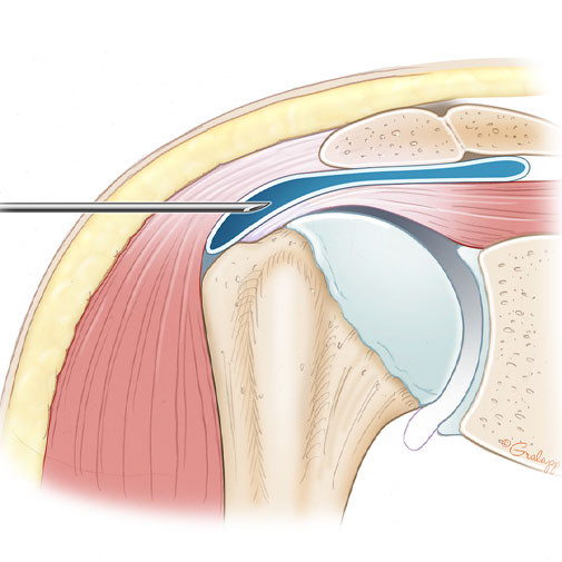 Subacromial Injection - Subacromial Shoulder Injection Ultrasound