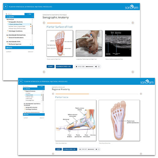 Plantar Fascia Ultrasound-Guided Injections Procedure Module