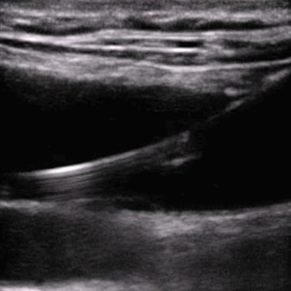 Thoracentesis Procedure - Ultrasound Guided Technique Training