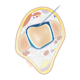 Tibiotalar Joint Effusion - Ultrasound-Guided Injection Training