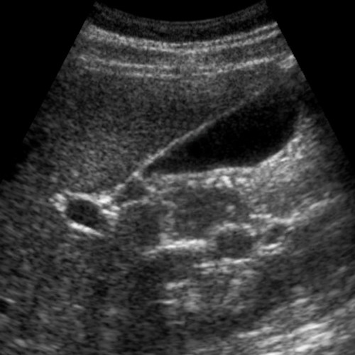 Ultrasound Training Bile Ducts Gallbladder Anatomy And Physiology