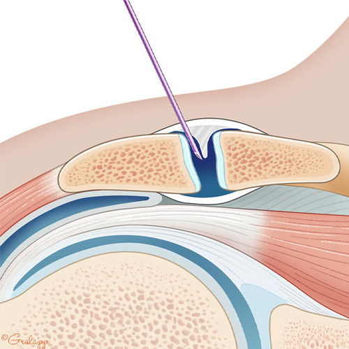 Ultrasound Training - Acromioclavicular Joint Injection Procedure
