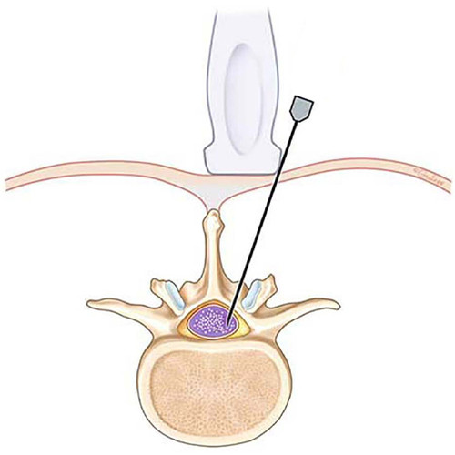 Neonatal Infant Lumbar Puncture Ultrasound Procedure