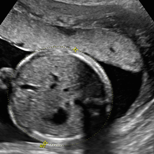Basic Obstetric Ultrasound Course - POCUS OB 6 Step