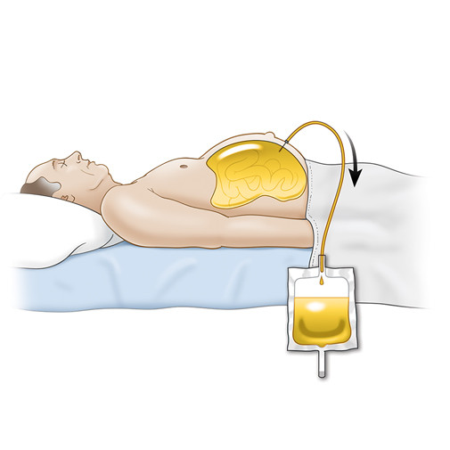 Paracentesis Procedure Training - Ultrasound-Guided Technique