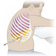 Thoracentesis Procedure - Ultrasound Guided Technique Training