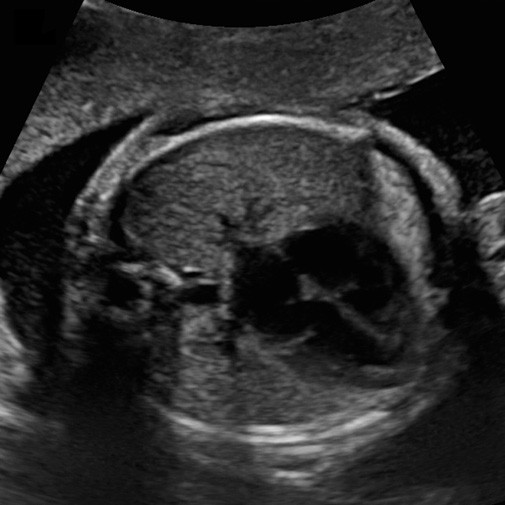 Basic Obstetric Ultrasound Course - POCUS OB 6 Step