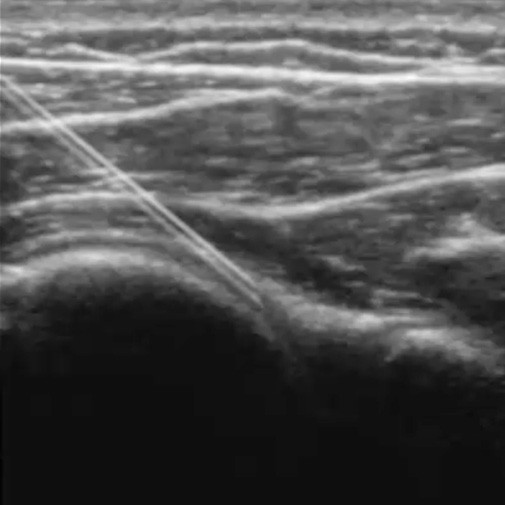 Ultrasound Training - Biceps Tendon Sheath Injection Procedure