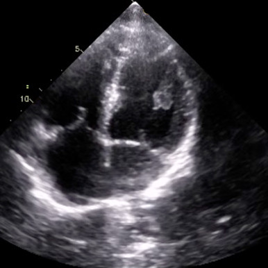 Heart Ultrasound - Heart Anatomy Ultrasound