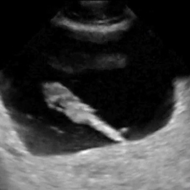 Ultrasound Training - Bladder Anatomy & Physiology