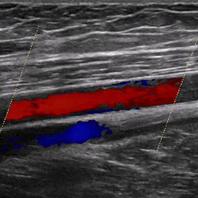 Leg Arterial Ultrasound - Training