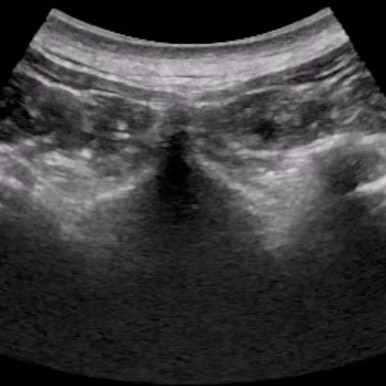 Spine Anatomy Ultrasound - Online Training Spine Ultrasound