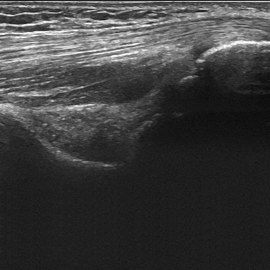 Elbow Ultrasound Training - Elbow Anatomy & Physiology