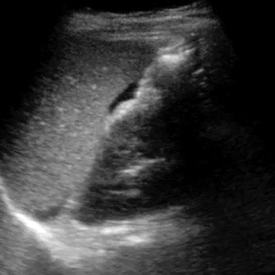 Clinical Ultrasound Training - eFAST Ultrasound Exam