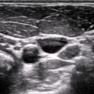 Internal Jugular Vein - Ultrasound Guided Cannulation
