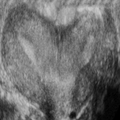 Clinical Ultrasound Training - Abnormal Uterus