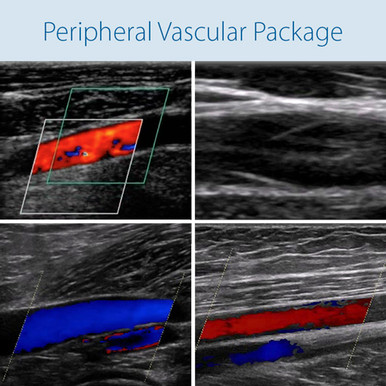Vascular Ultrasound Training - Peripheral Vascular Disease Ultrasound