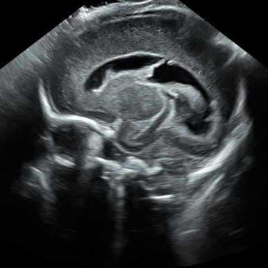 Neonatal Ultrasound - Neurosonography - Clinical Ultrasound Training